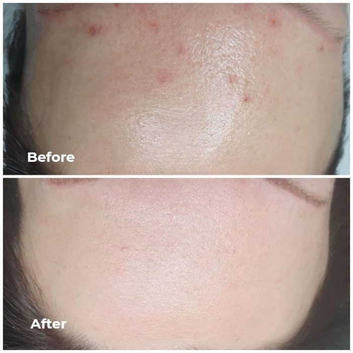 MTS Skin Repair - Microneedling - Cheongdam 청담 Korean Skin Management