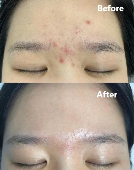 MTS Skin Repair - Microneedling - Cheongdam 청담 Korean Skin Management