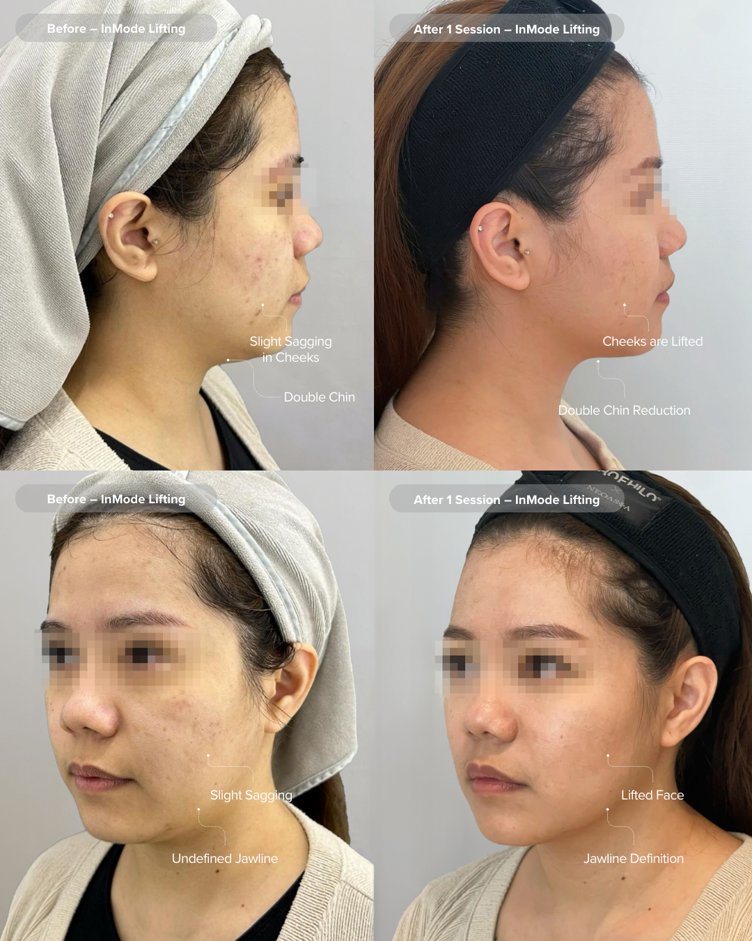 InMode Lifting - Cheongdam 청담 Korean Skin Management